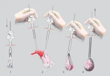 Endo Catch Bag - Laparoscopic Surgical Sampling Bag 100 Ml