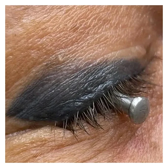 Stainless Steel Ocular Laser Shields for Surgical Safety