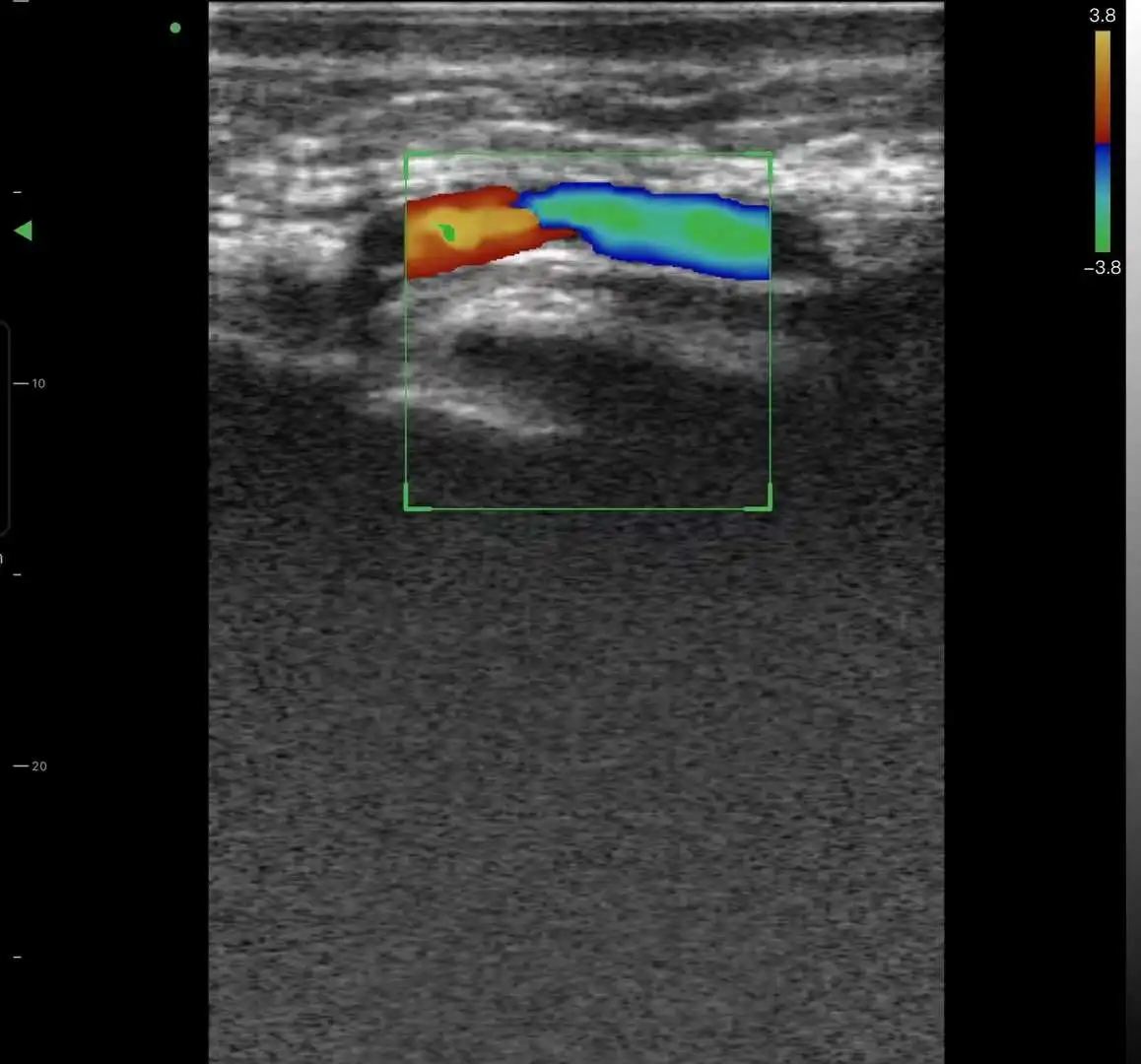 MSLPU96 - 16mhz 20mhz MSK Linear Color Doppler Ultrasound