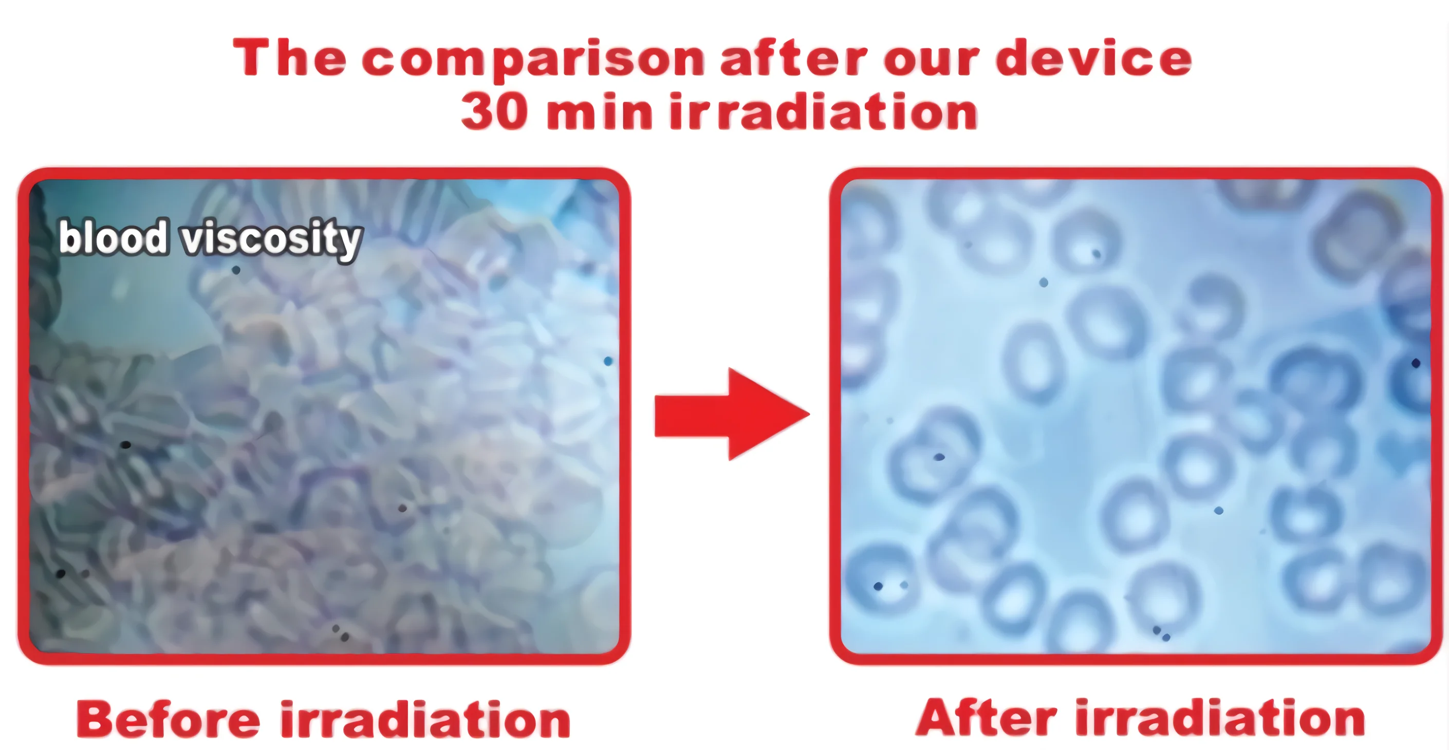 Rhinitis Treatment Instrument Allergic Rhinitis Artifact Sinusitis ...