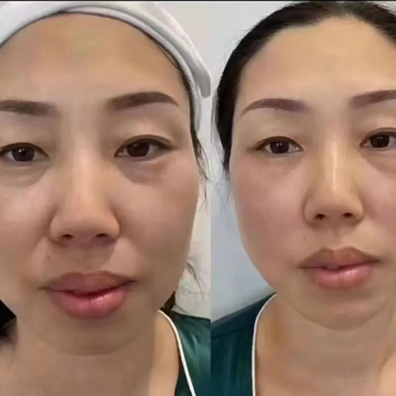 Hifu 2024 New Model Focused Ultrasound Professional Face Lifting ...