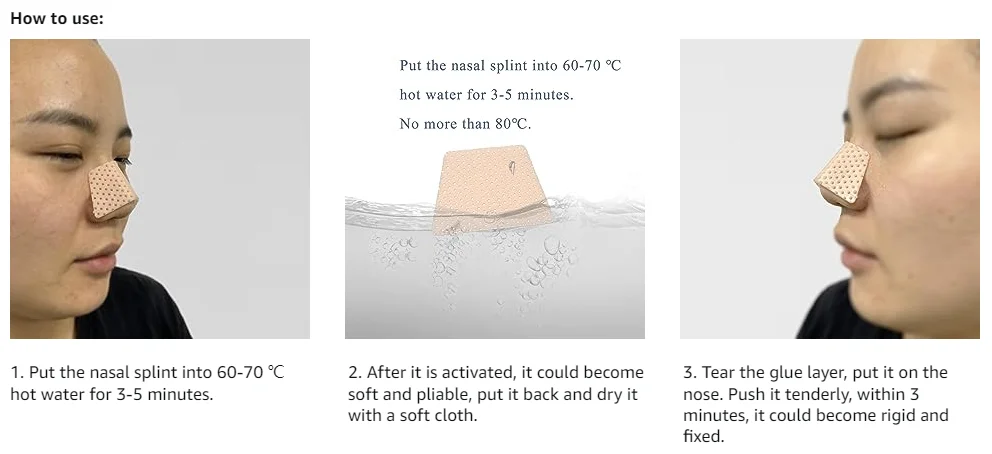 Thermoplastic Nasal Splint for Rhinoplasty & Rehabilitation