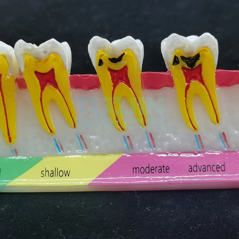 Teeth Periodontal Disease Model - Dental Education Tool