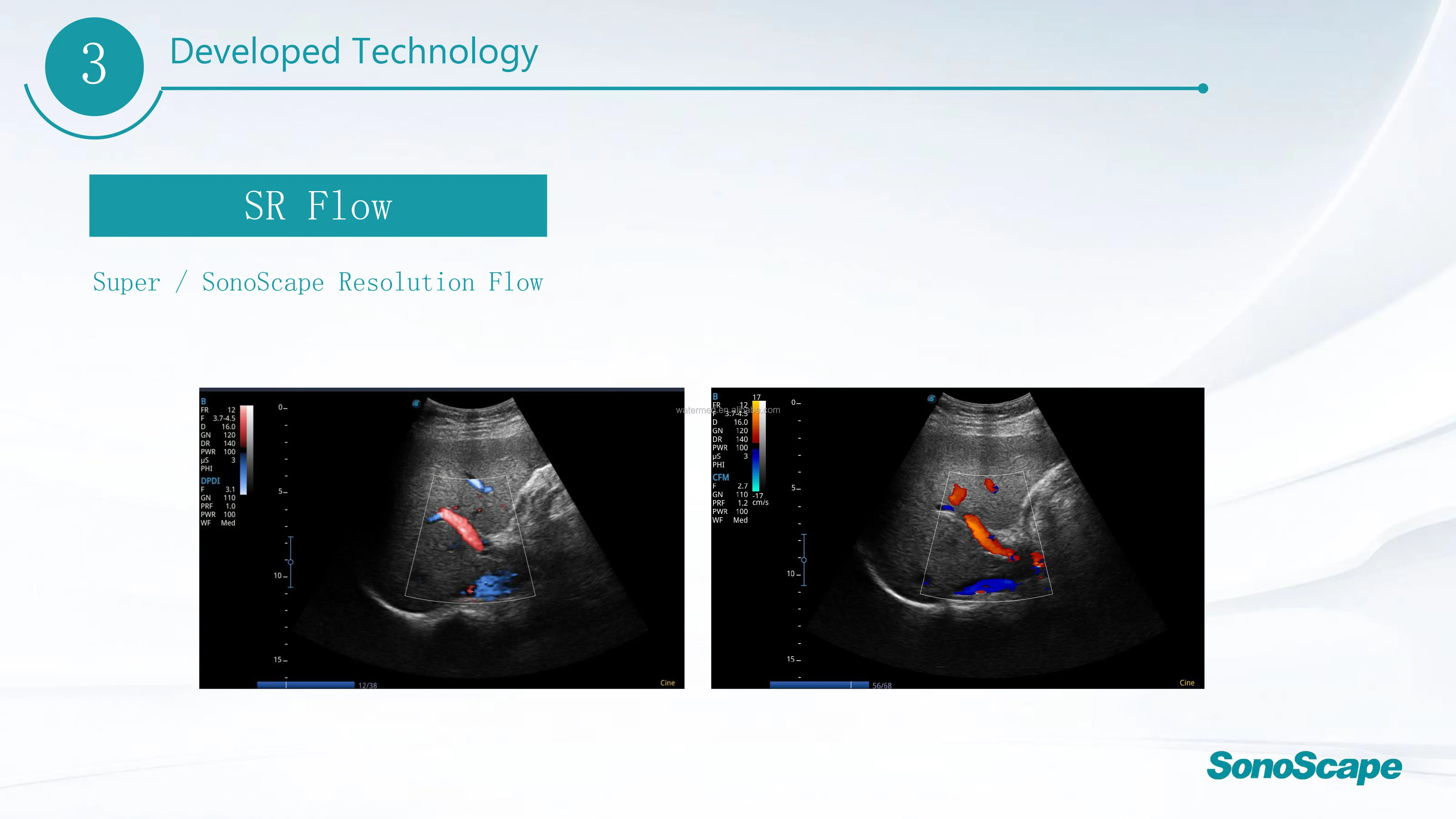 MSK Ultrasound TDI CW Color Sonoscape E2 E3 & Sonoscape E1 Usg