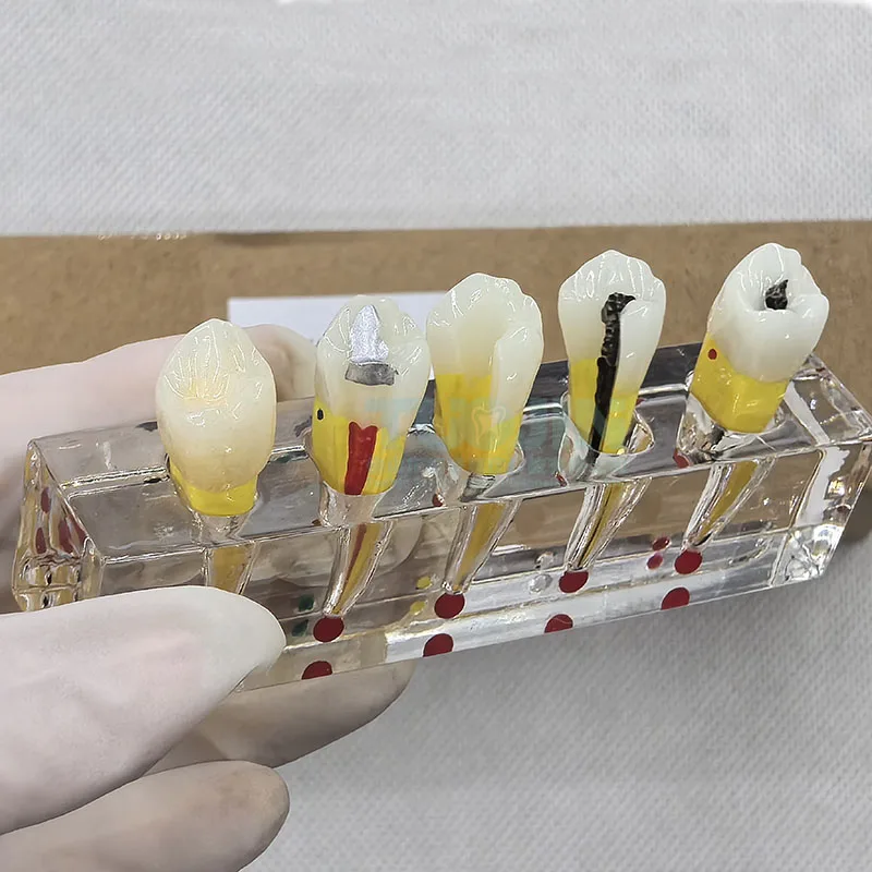 Endodontic Pathological Model Pathology Patient Communication Model ...