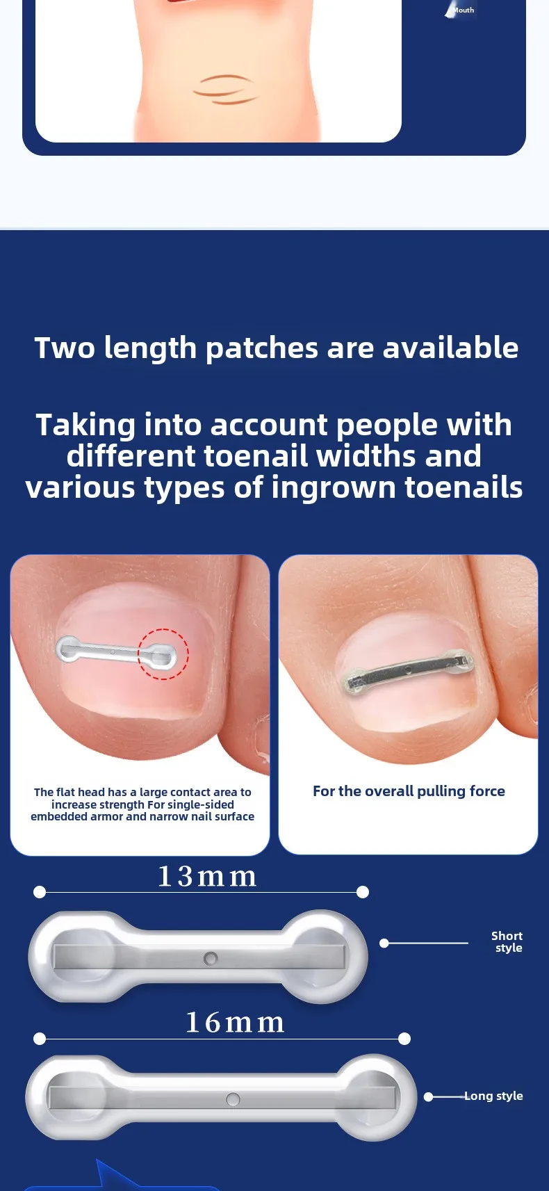 Ingrown Nail Bionic Bone Patch Titanium Alloy Inlaid Nail Steel Wire ...