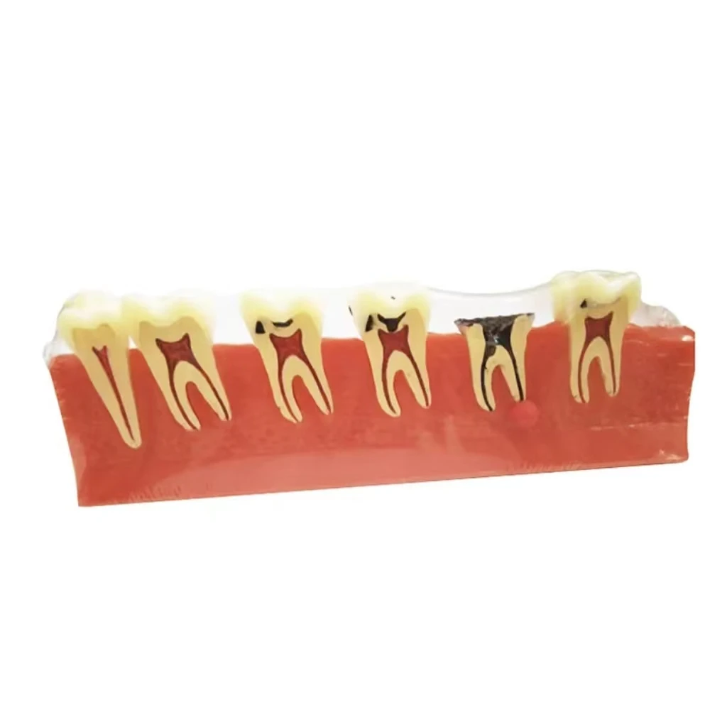 High Quality Sectioned Dental Pulp Disease Model Periodontal Diseases ...