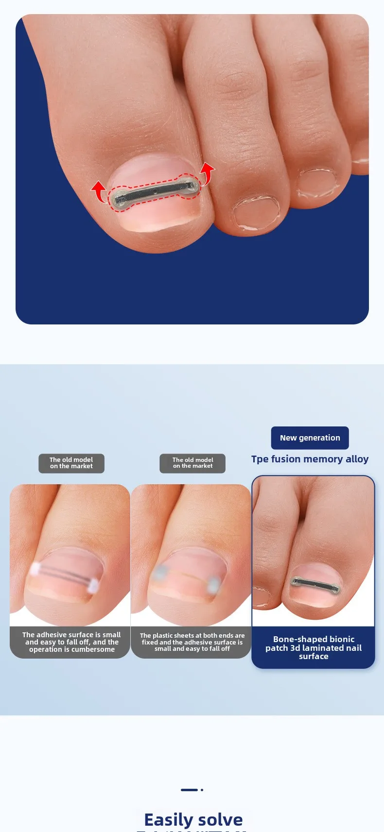 Ingrown Nail Bionic Bone Patch Titanium Alloy Inlaid Nail Steel Wire ...