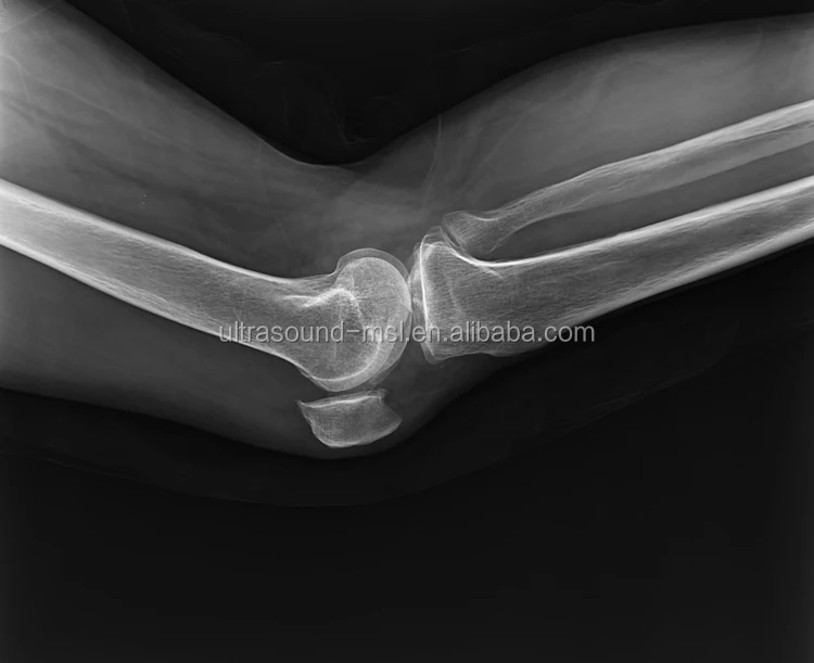 DR FPD X-Ray Imaging - 14X17 Digital Flat Panel Detector