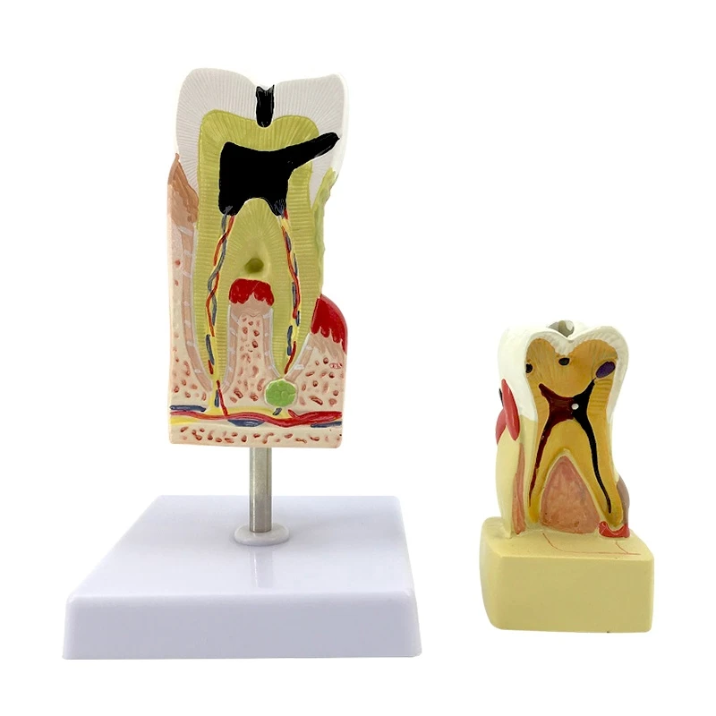 Tooth Decay Model - Comprehensive Pathological Dental Anatomy