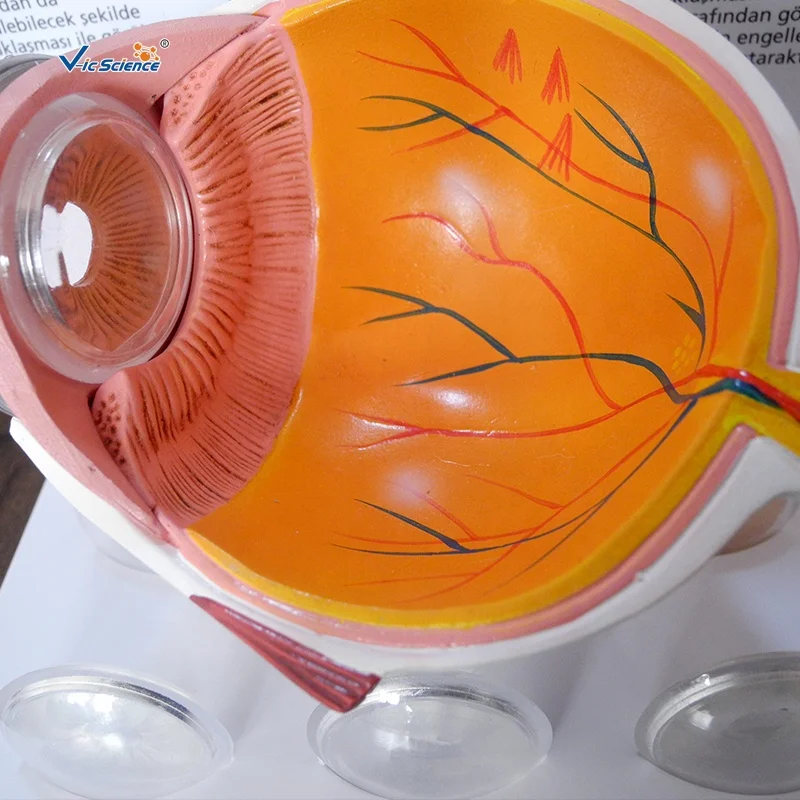 Human Eyeball Cataract Anatomy Model for Medical Education