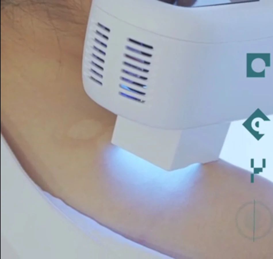 Kernel 308 Nm Excimer Led Uvb Phototherapy For Psoriasis/ Viyiligo ...