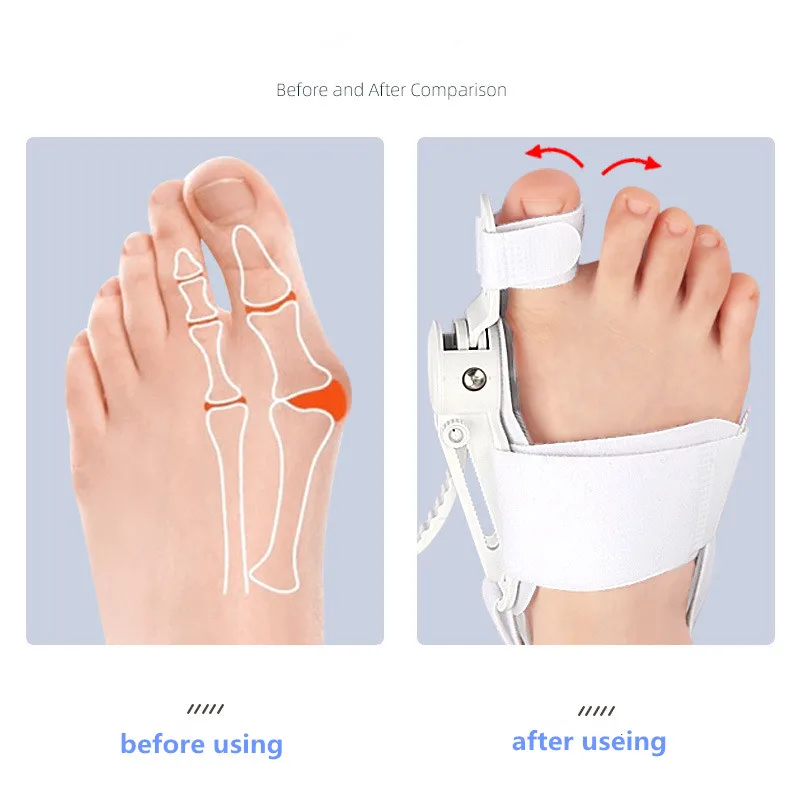 Bunion Orthoticsbig Foot Protruding Overlapping Toe Separatorknob Snap ...