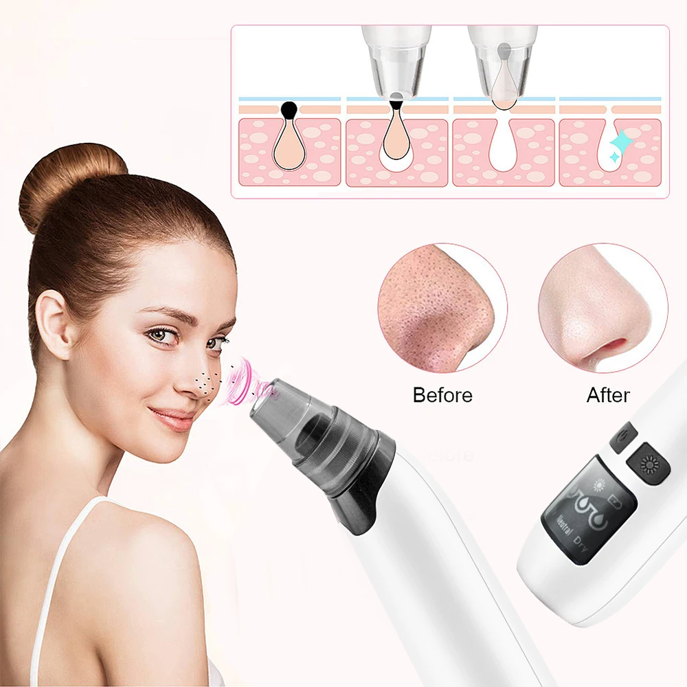 Hot Electric Pimple Removal Suction Extractor Tool Kit