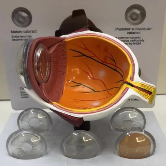 Glaucoma And Cataract Eye Model,Medical Science Model Of Ophthalmic ...