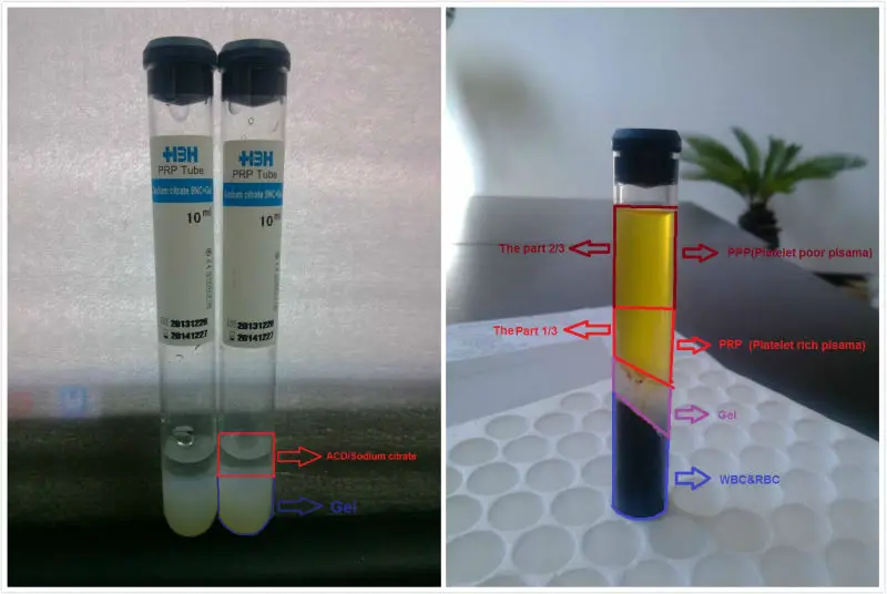 8ml,10ml,12ml,15ml Prp Tube With Medical Grade Sterile Blister Package ...