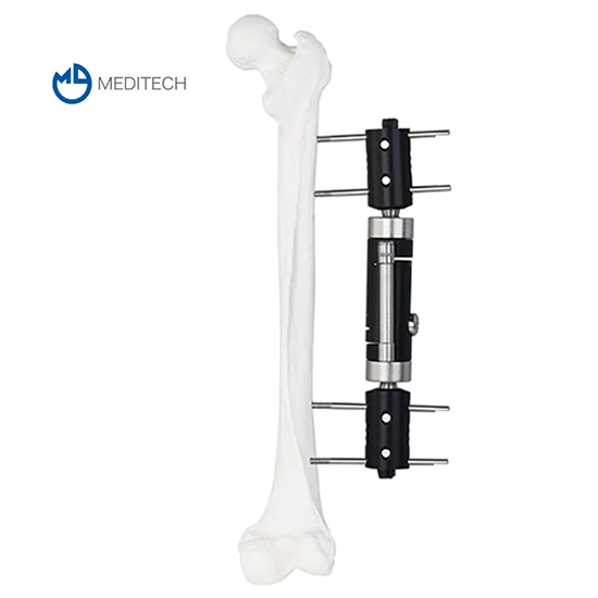Bone Lengthening External Fixator Orthopedic External Fixation - Buy ...
