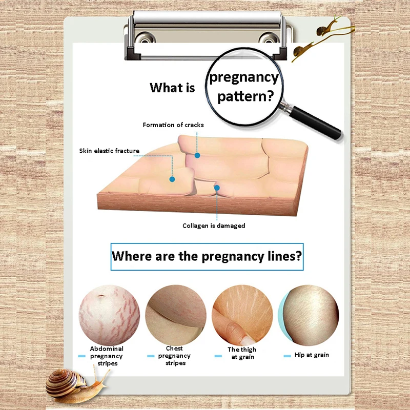 Aichun Beauty Skin Care Anti Stretch Marks Natural Fast Stretch Marks ...