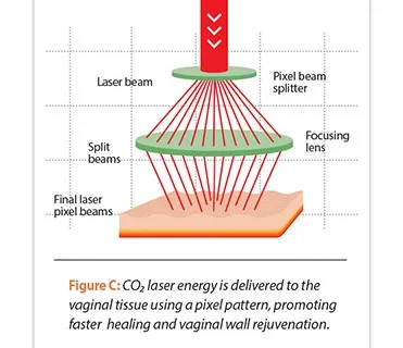 Alma Lasers Femilift - Buy Vaginal Tightening,Stress Urinary ...