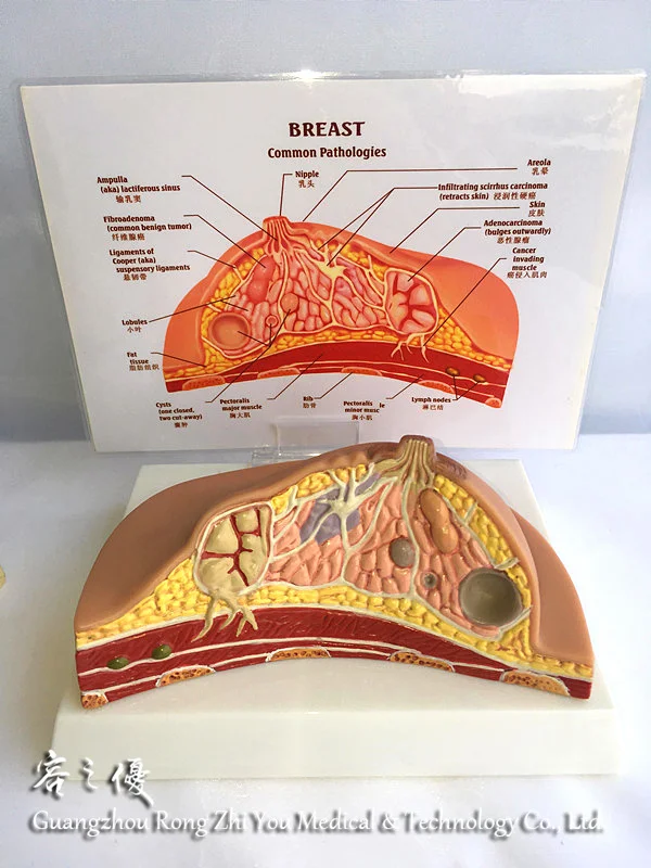 R150105 Medical Supply - Pathological Breast Model for Education