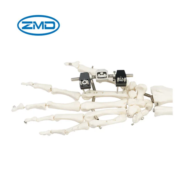 Finger External Fixator Kit With Screw Mini Fragment 10109a Orthopedic ...