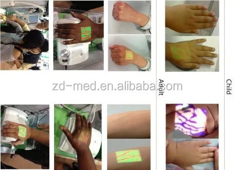 Vein Viewing Blood Vessel Finder/scanner - Buy Injection Use Portable ...