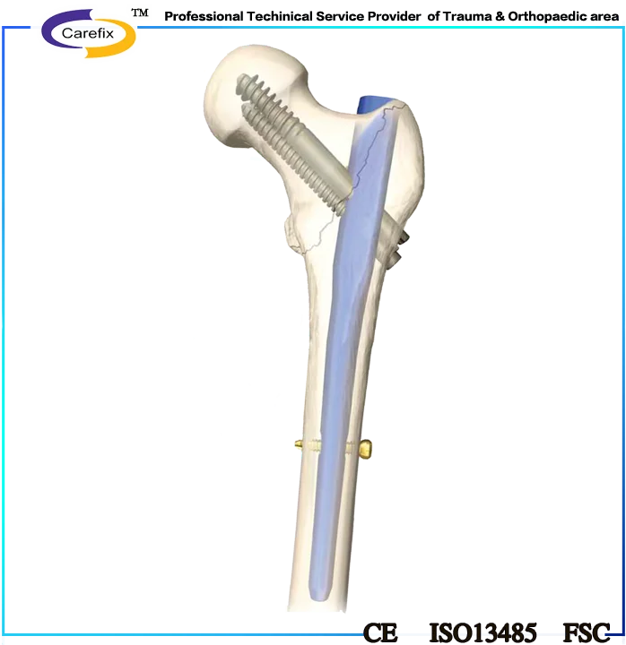 Carefix Femur And Tibia Interlocking Nail,Metallic Intramedullary Nail ...