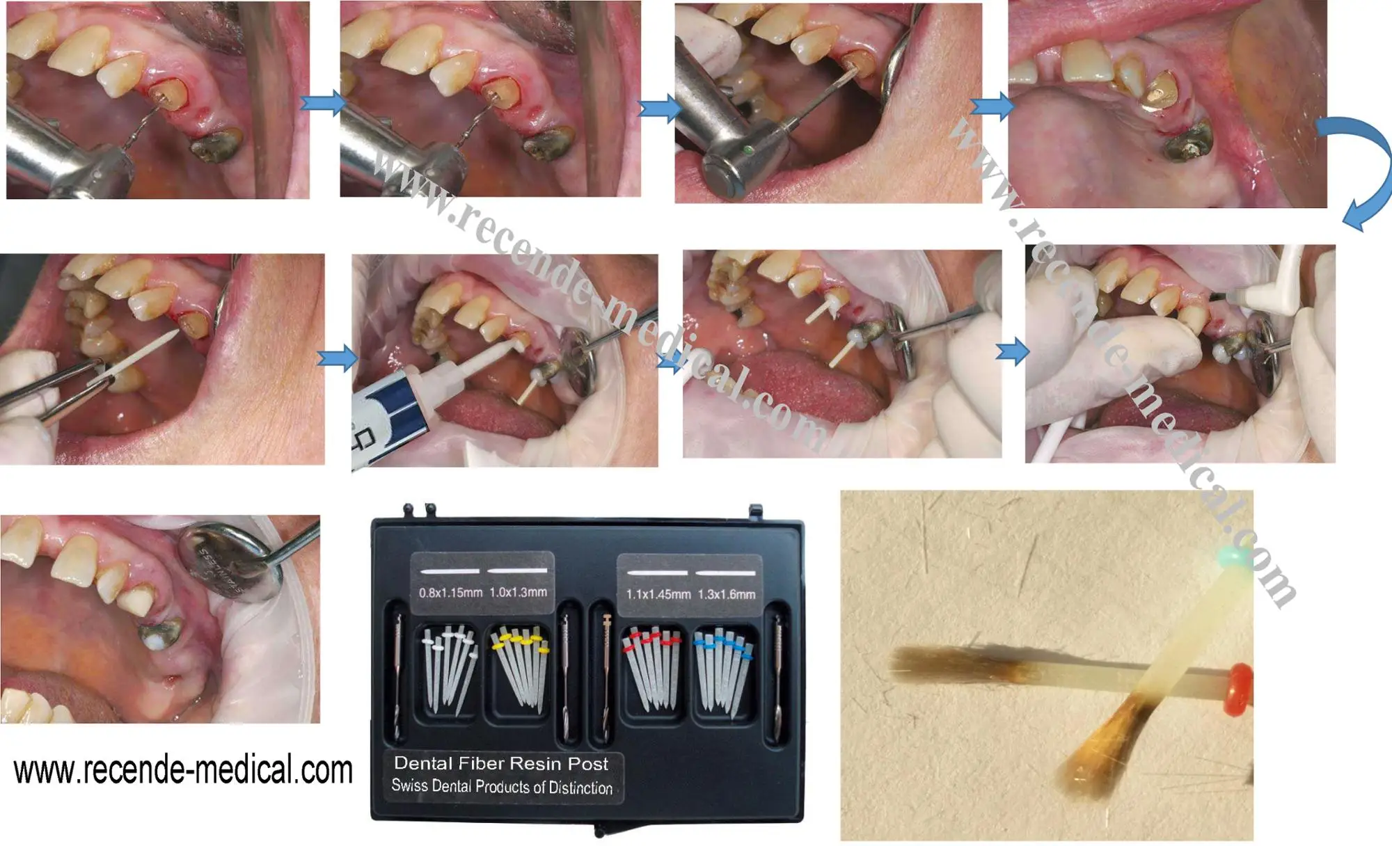 Dental Fiber Resin Posts - Reliable and Versatile Solutions