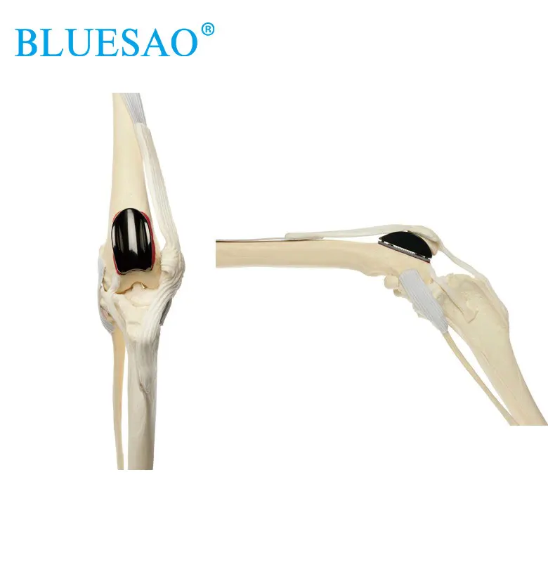 Patellar Groove Replacement Implanted Prosthesis Size 6 And Trial ...