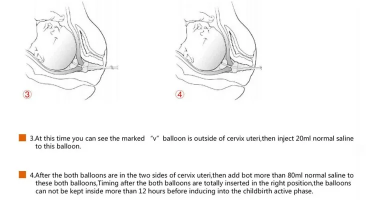 Disposable Dilatation Cervical Ripening Balloon Catheter - Buy Cervical ...