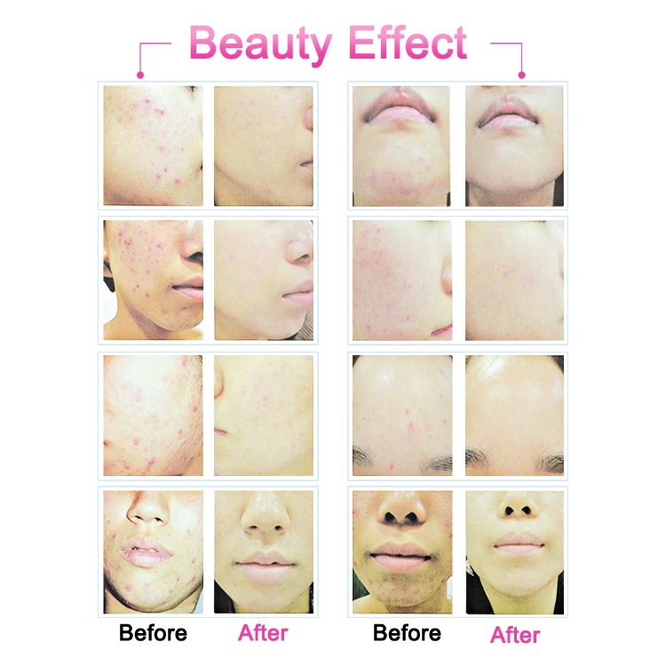 Led Mask Photon Party Neutrogena - Buy Led Mask Photon,Led Mask Party ...