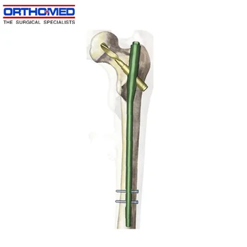 Fna Medical Proximal Femur Interlocking Intramedullary Nail - Buy Pfna ...