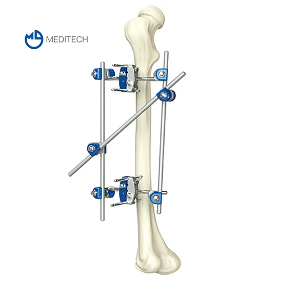 Bone Lengthening External Fixator Orthopedic External Fixation - Buy ...