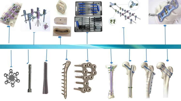 Femur Neck Locking Compression Plate With Cannulated Locking Screw Lcp ...