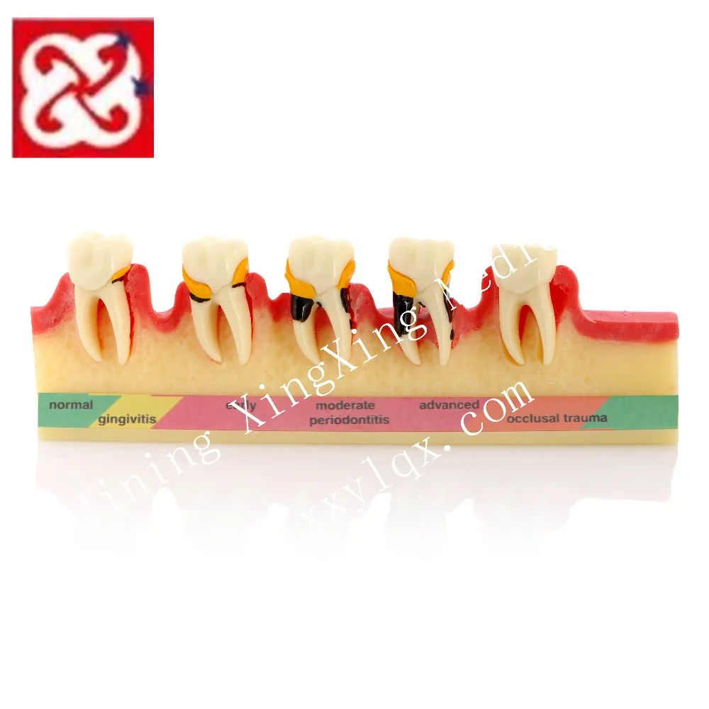 Progress Of Periodontal Disease Anatomical Model - Buy Periodontal ...