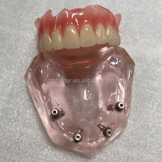 Educatief Bovenste Onderkaak Implant Model Tanden Overkappingsprothese ...