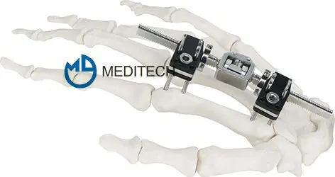 China Supplier Mini Fragment Finger Aluminium External Fixator - Buy ...