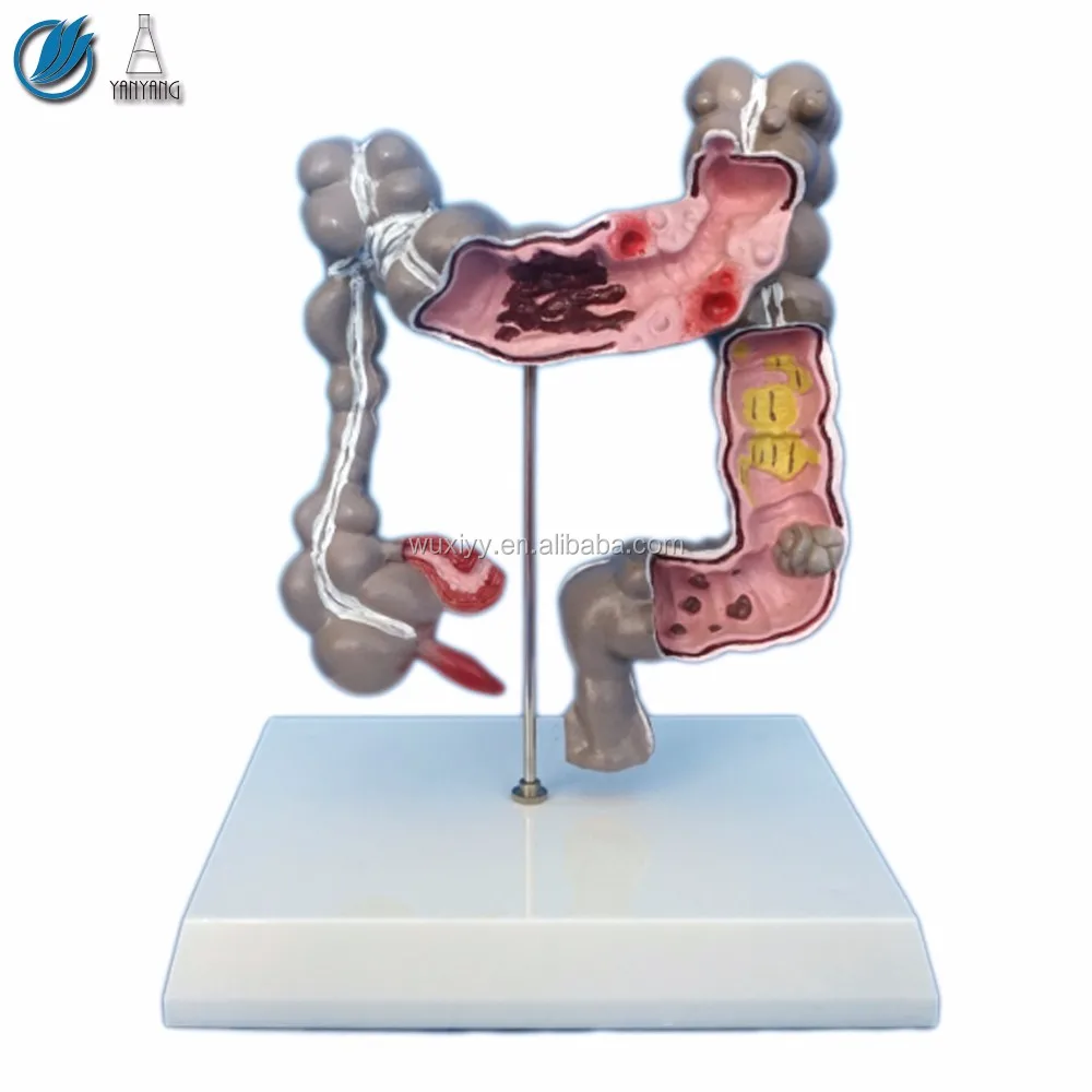 Human Common Pathologies of Colon and Rectum Model - Anatomical ...