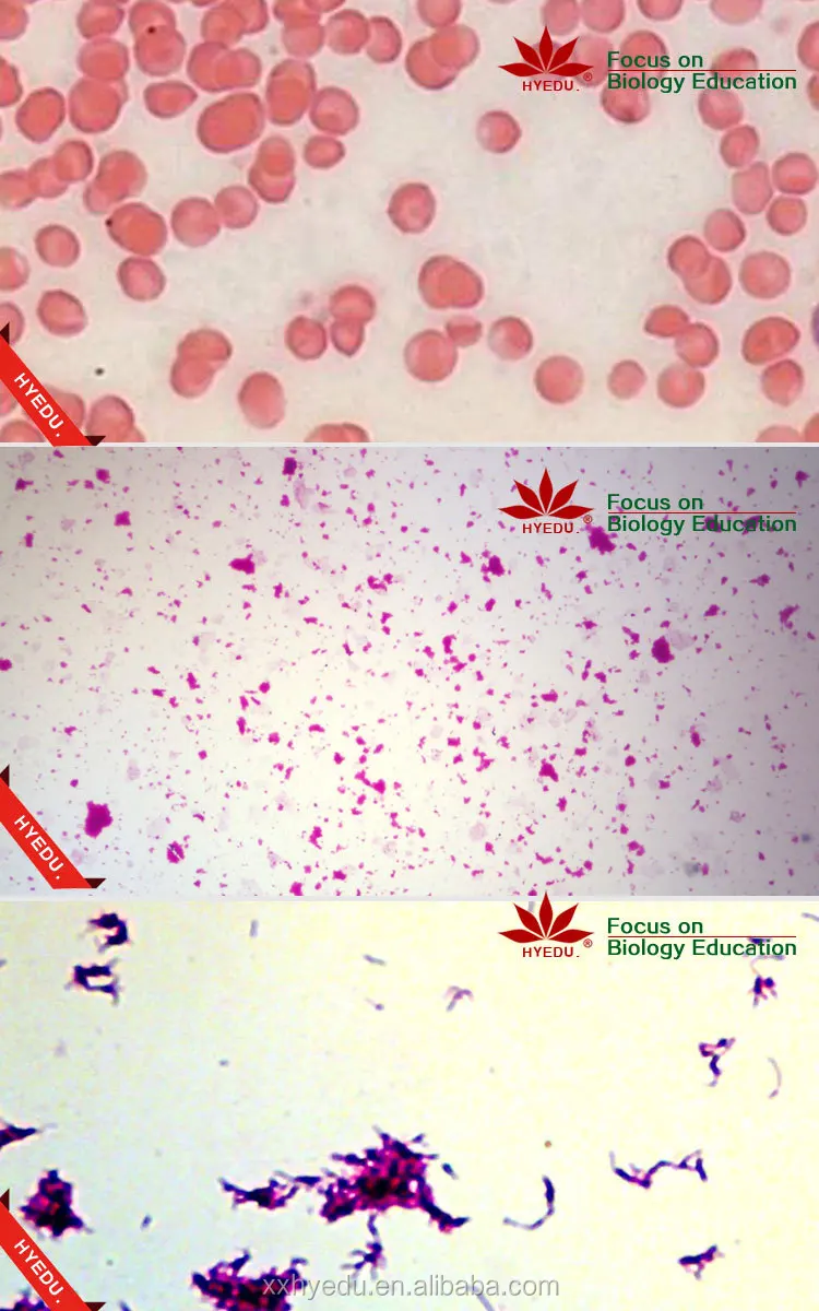 Individual Acute Lymphoblastic Leukemia Smear(l1) Slides