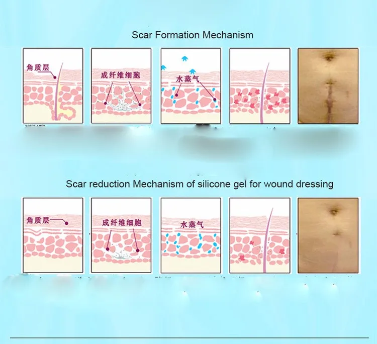Veiligheid Survival C-sectie Keizersnede Siliconengel Scar Therapy ...