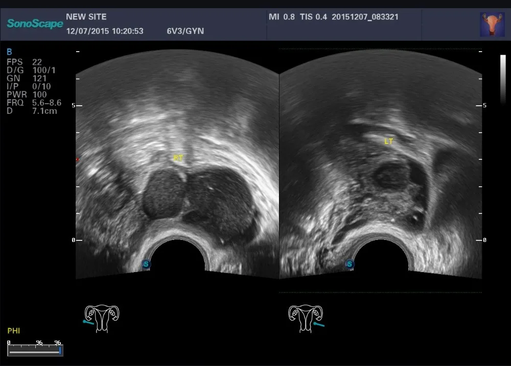 Sonoscape E2 Ultrasound Machine - Portable and Versatile