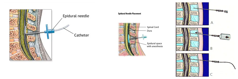 Medical Hospital Use 16g Epidural Needles - Buy Epidural Needles,16g ...