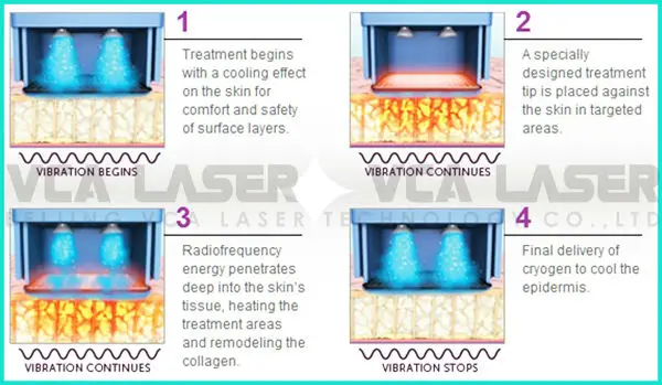 Thermage New Thermagic rf Face lifting Thermagic Fractional Rf Machine ...