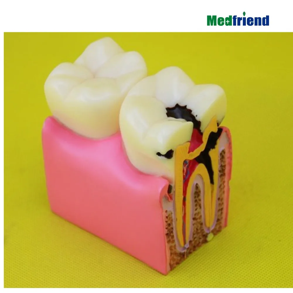 Model Of Dental Pathology 6x Teeth Comparasion Study Model Tooth Decay ...