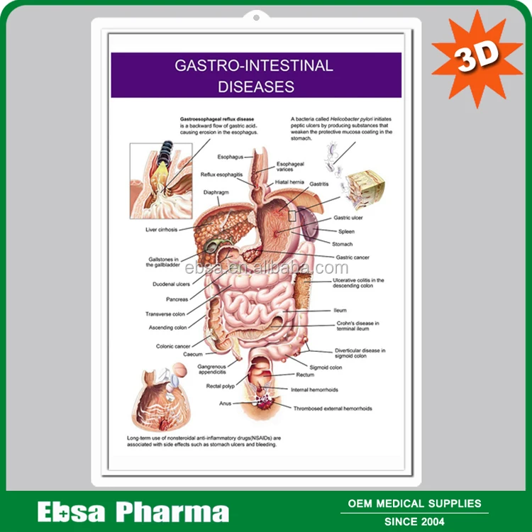 3D Medical Human Anatomy Wall Charts - Gastro Intestinal Diseases