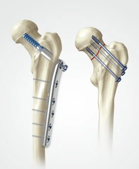 1 Piece Gooseneck Screw 130 Degree (dhs),Distal Femur Locking Plate ...