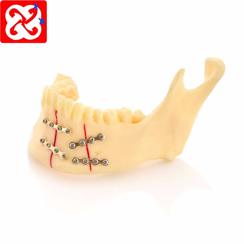 Bone Fracture Restoration Jaw Model - Detailed Anatomy