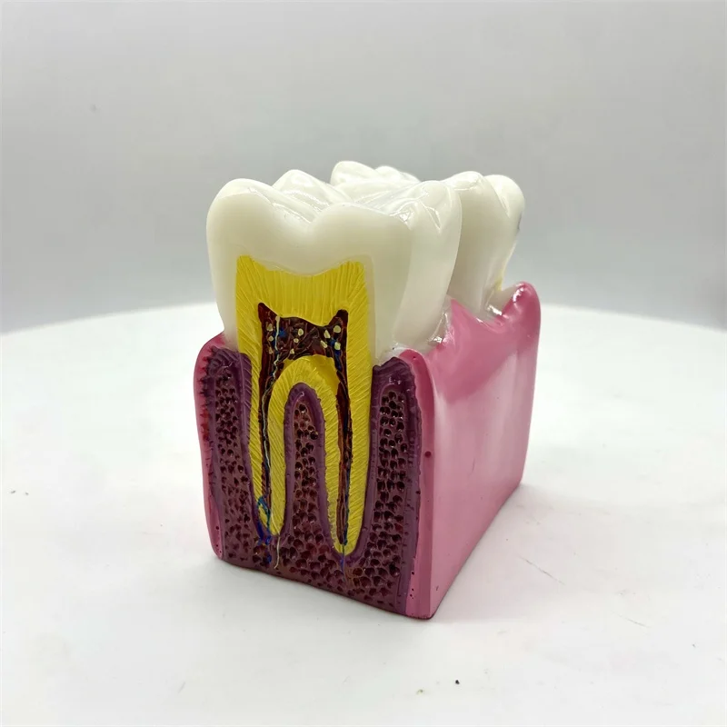 Dental Models M4021 Caries demonstration model with healthy teeth oral ...