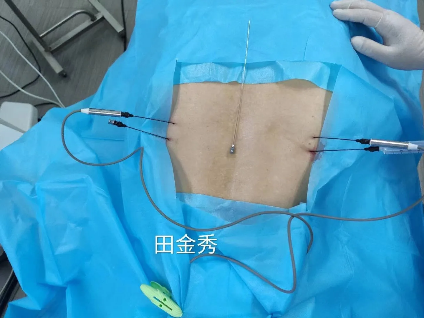 Radiofrequency Thermolesion Generator For Neurosurgery Brain Lesion And ...