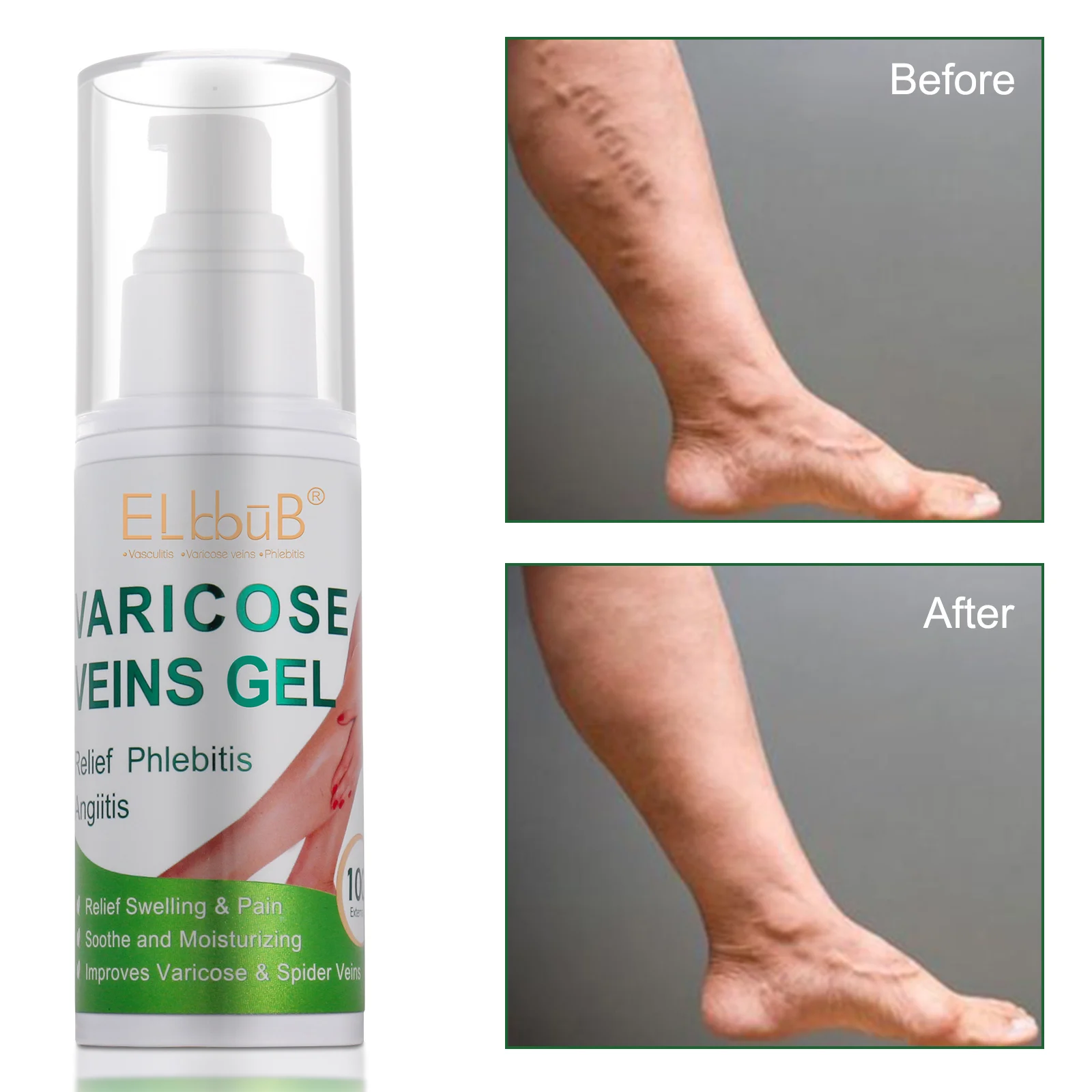 Elbbub Varicose Vein Treatment Removes Veniselle Cream Para Varices For ...